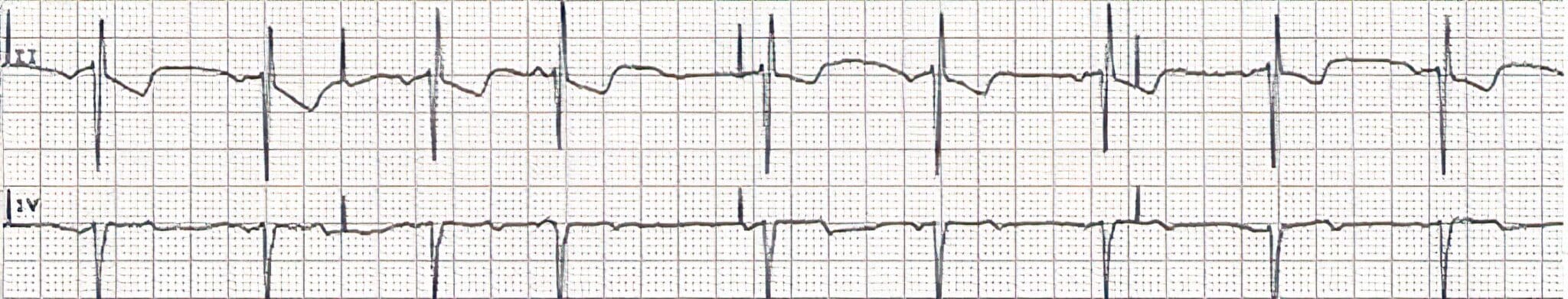 Topic - Undersensing | 12-Lead ECG Certification Course | ACLS ...