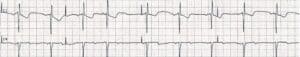 Topic - Undersensing | 12-Lead ECG Certification Course | ACLS ...