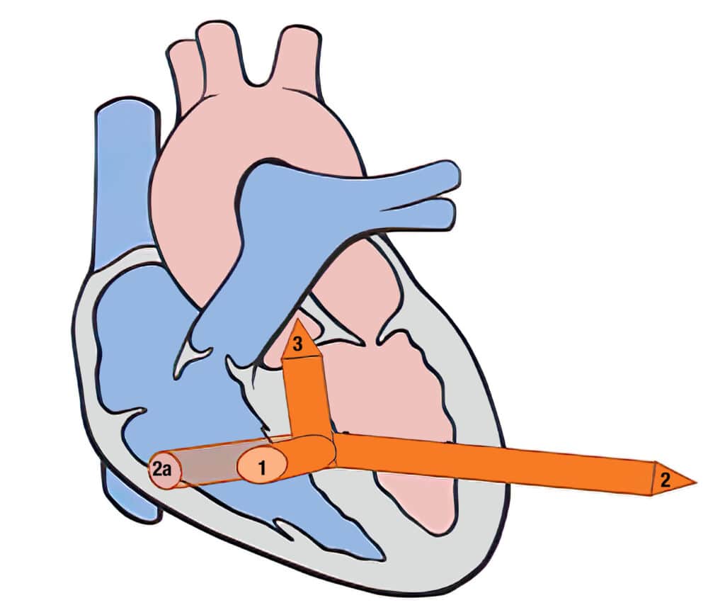 Topic - The QRS Vectors | 12-Lead ECG Certification Course | ACLS ...