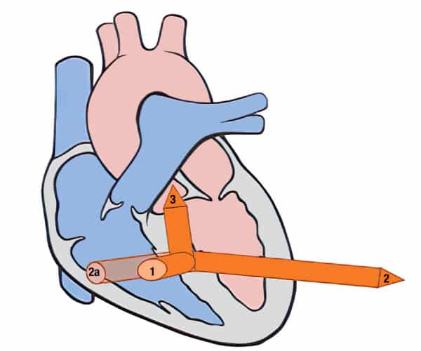 Topic - The QRS Vectors | 12-Lead ECG Certification Course | ACLS ...
