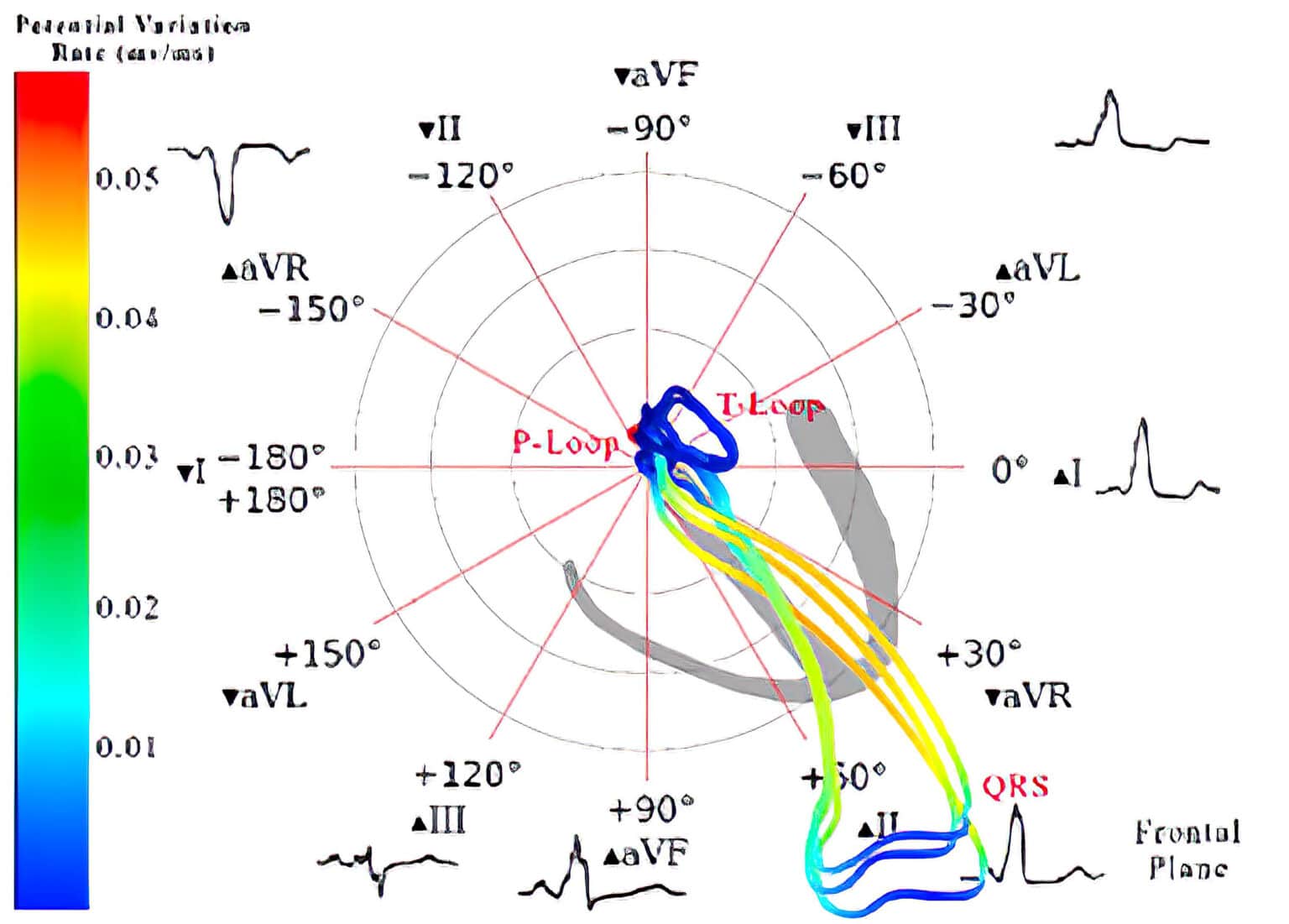 Topic - Complete Left Bundle-Branch Block | 12-Lead ECG Certification ...