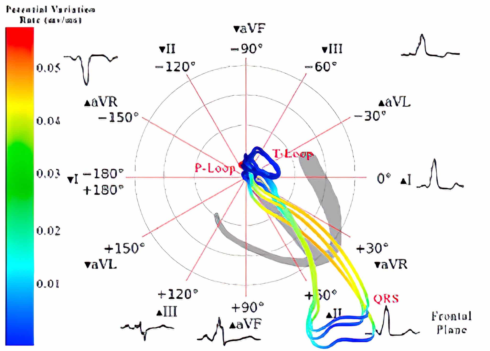 Topic - Complete Right Bundle-Branch Block | 12-Lead ECG Certification ...