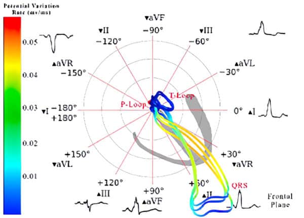 Topic - Complete Right Bundle-Branch Block | 12-Lead ECG Certification ...