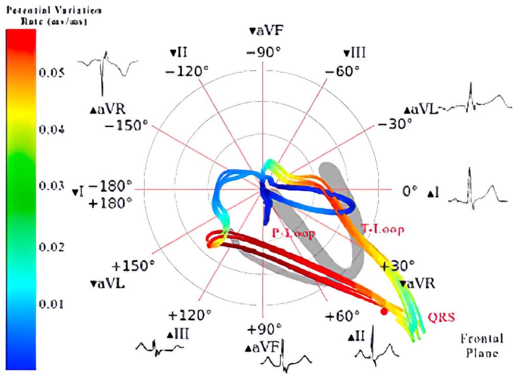 Topic - Complete Right Bundle-Branch Block | 12-Lead ECG Certification ...