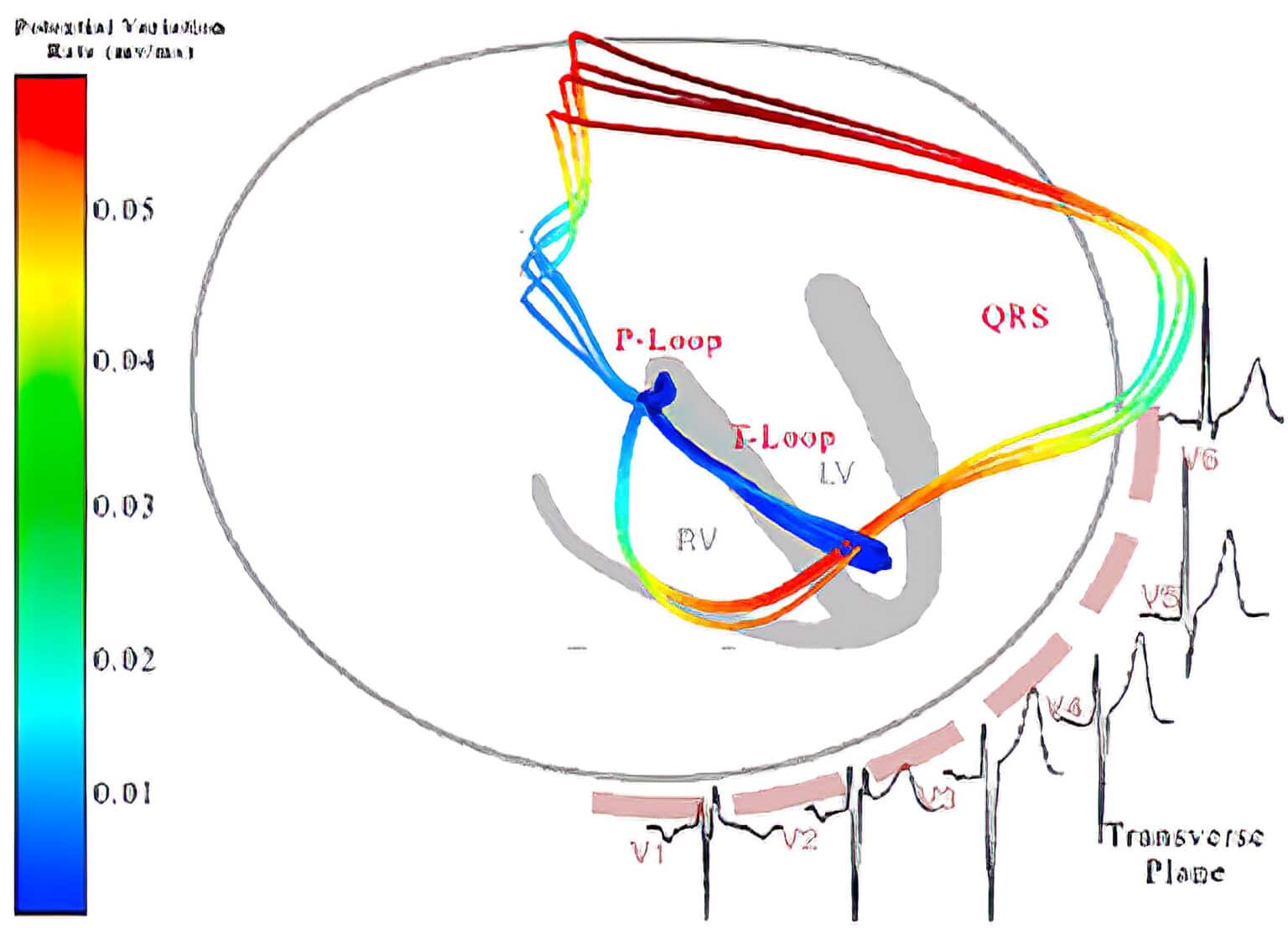 Topic - Complete Right Bundle-Branch Block | 12-Lead ECG Certification ...