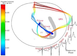 Topic - Complete Right Bundle-Branch Block | 12-Lead ECG Certification ...