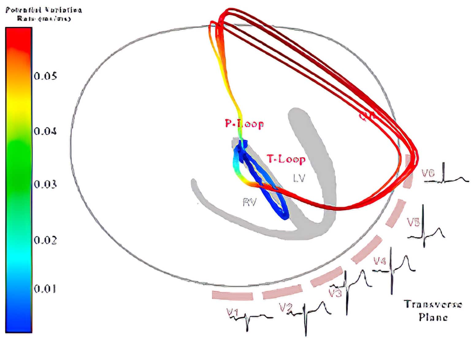 Topic - Complete Right Bundle-Branch Block | 12-Lead ECG Certification ...