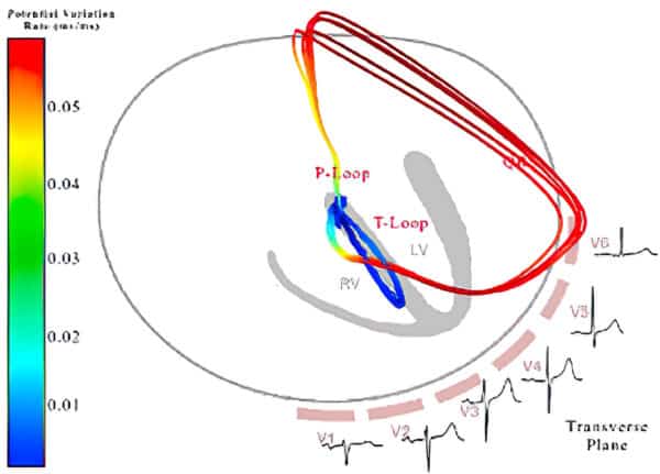 Topic - Complete Right Bundle-Branch Block | 12-Lead ECG Certification ...