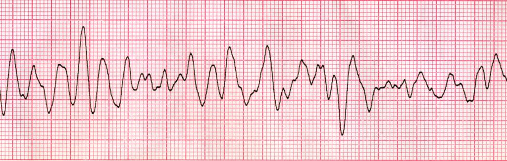 Topic - The PALS Cardiac Arrest Algorithm | PALS Course | ACLS ...