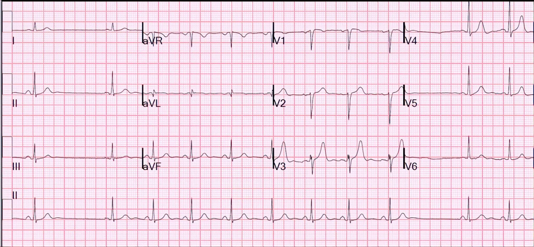 Topic - Electrocardiogram Characteristics of Sinus Node Dysfunction ...