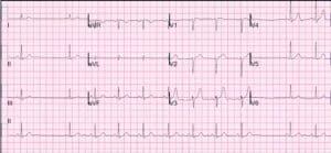 Topic - Electrocardiogram Characteristics of Sinus Node Dysfunction ...