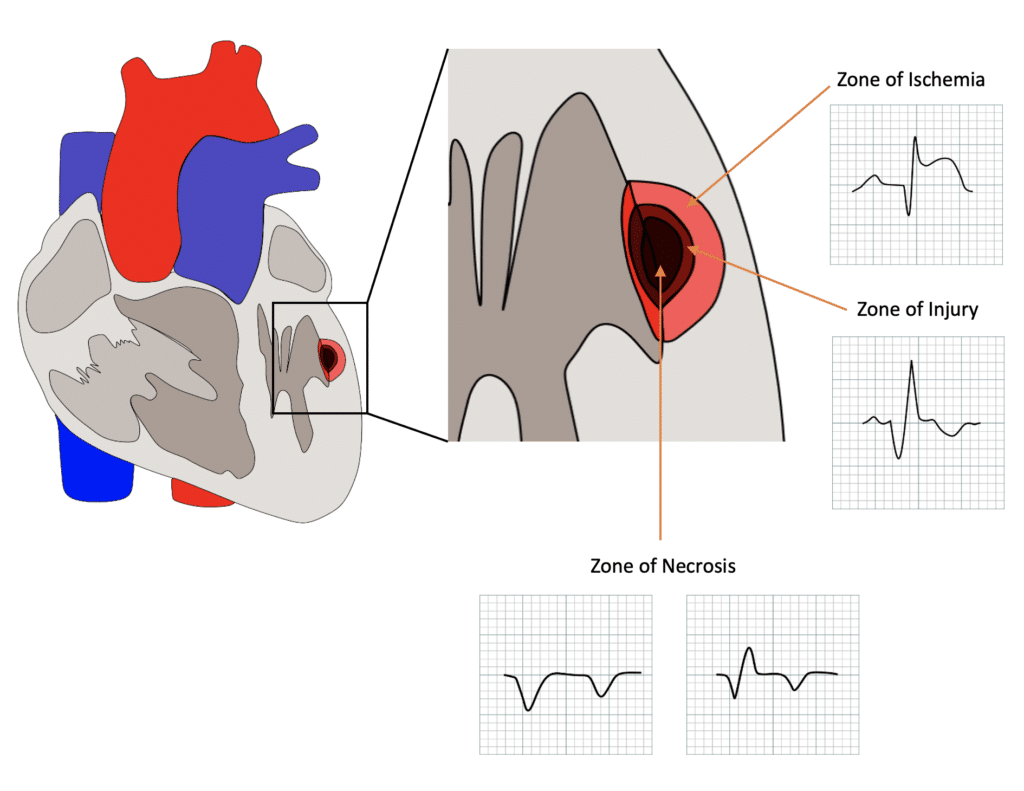 Topic - Electro Pathophysiology | 12-Lead ECG Certification Course ...