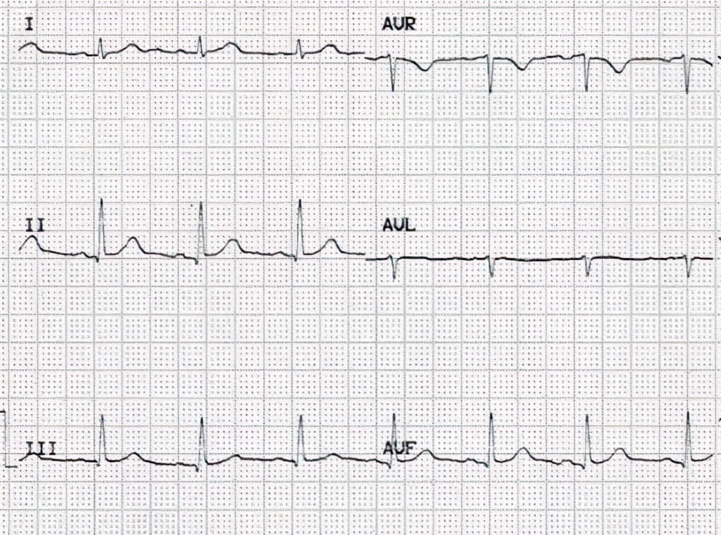 Topic - The Cardiac Axis | 12 Lead ECG Course | ACLS Certification ...