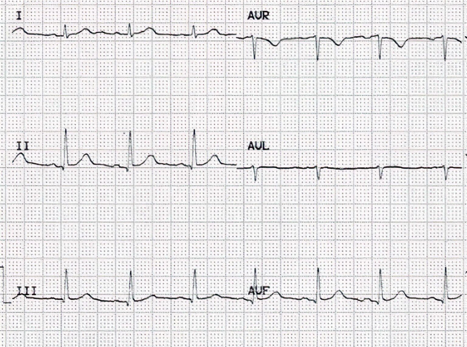 Topic - The Cardiac Axis | 12 Lead ECG Course | ACLS Certification ...