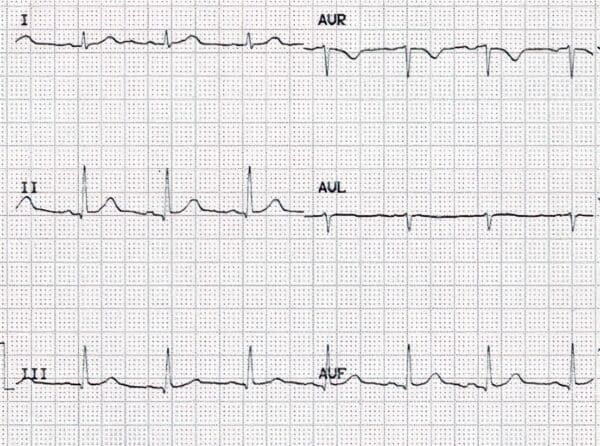 Topic - The Cardiac Axis | 12 Lead ECG Course | ACLS Certification ...