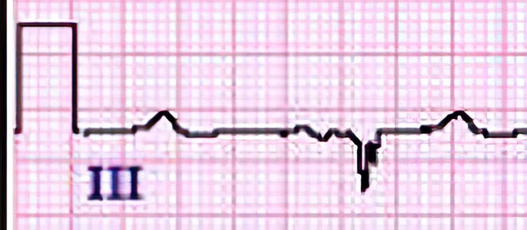 Topic - The QRS Complex | 12-Lead ECG Certification Course | ACLS ...