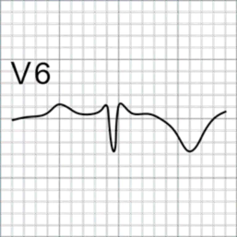 Topic - Special Infarction Patterns | 12-Lead ECG Certification Course ...