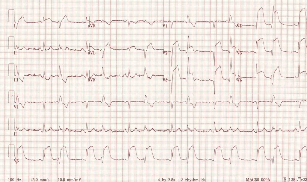 Topic - Checklist for Fibrinolytic Therapy | ACLS EP Course | ACLS ...