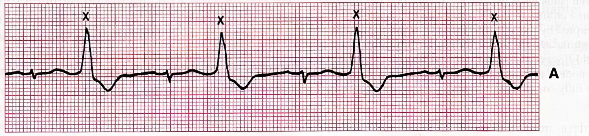 Topic - Diagnosing and Treating Tachycardias | ACLS EP Course | ACLS ...