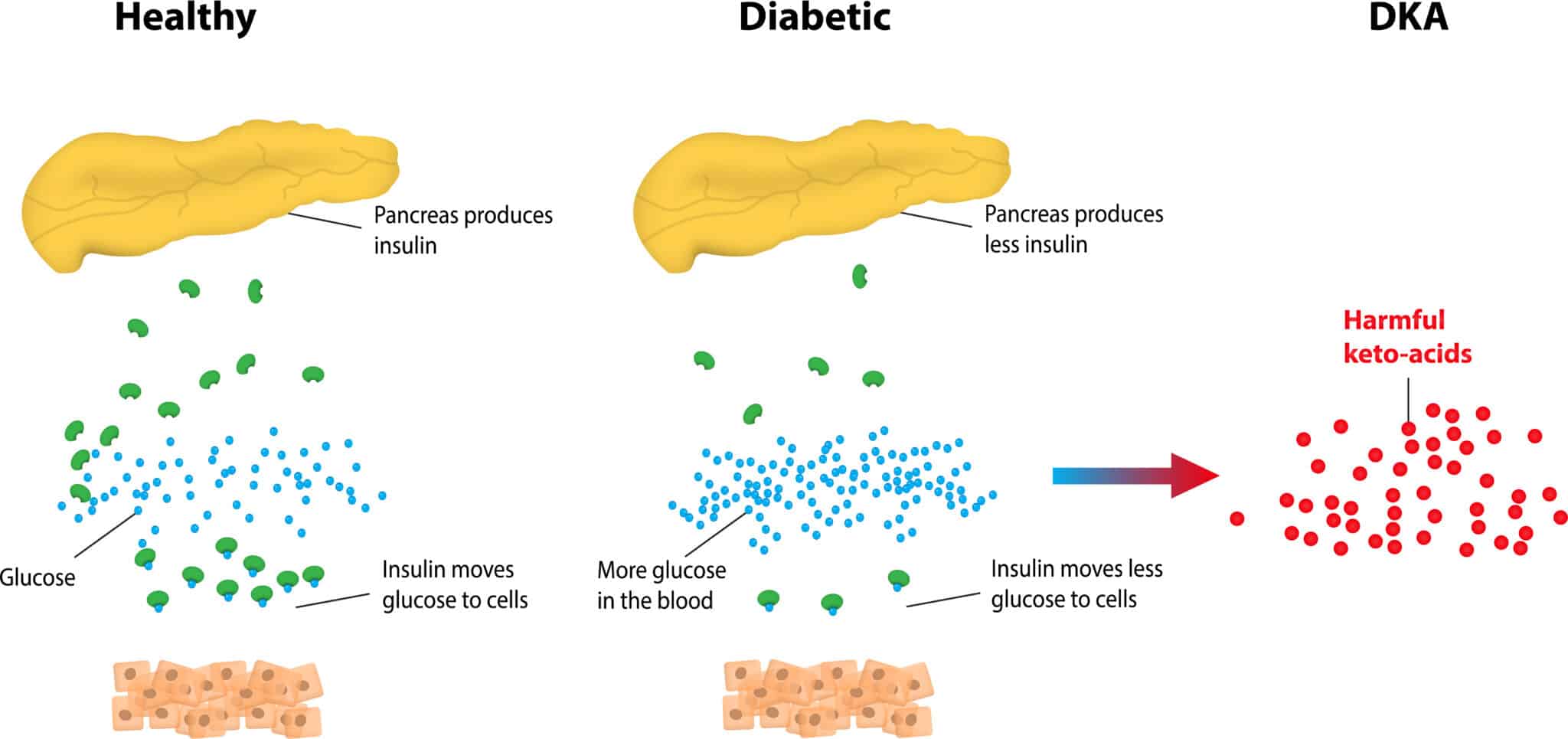 Topic - Diabetic Ketoacidosis (DKA) | ACLS EP Course | ACLS ...