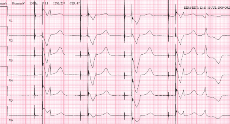 Topic - Using Pacing | ACLS EP Course | ACLS Certification Association