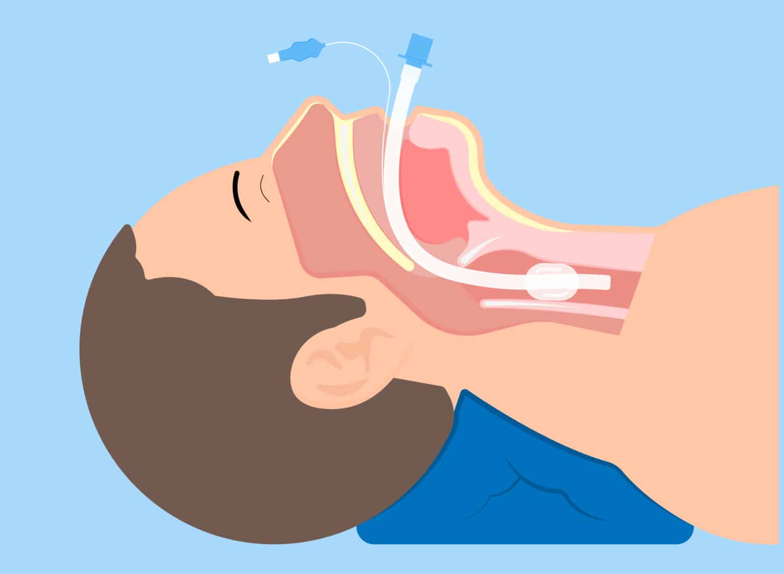 Topic - Airway Adjuncts | ACLS EP Course | ACLS Certification Association