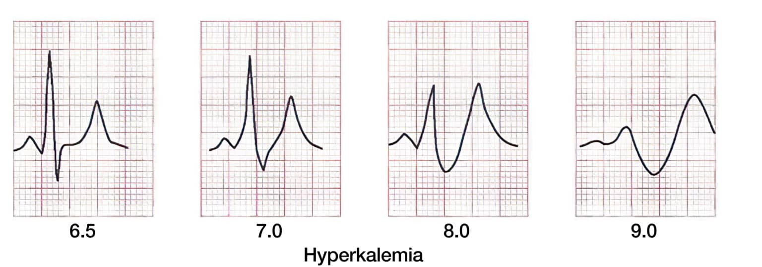 Topic - Potassium | ACLS EP Course | ACLS Certification Association