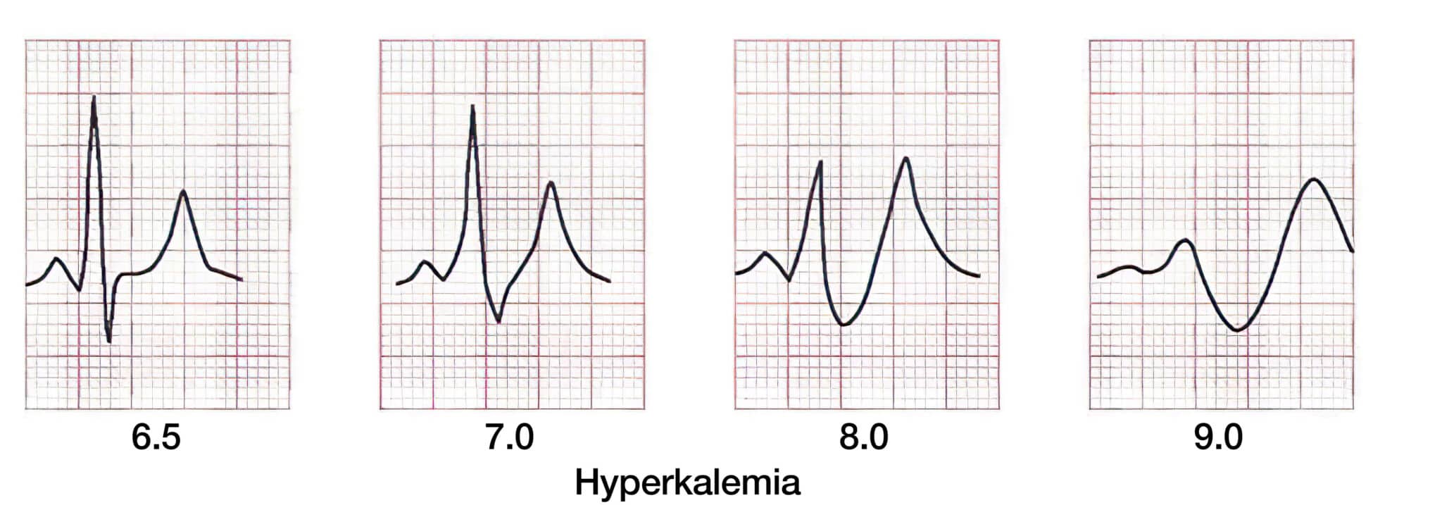 Topic - Potassium | ACLS EP Course | ACLS Certification Association