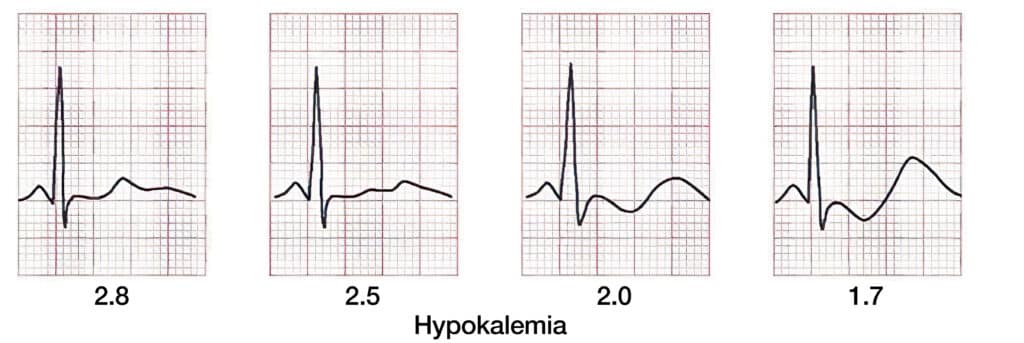 Topic - Potassium | ACLS EP Course | ACLS Certification Association