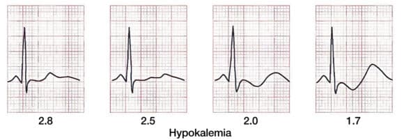 Topic - Potassium | ACLS EP Course | ACLS Certification Association