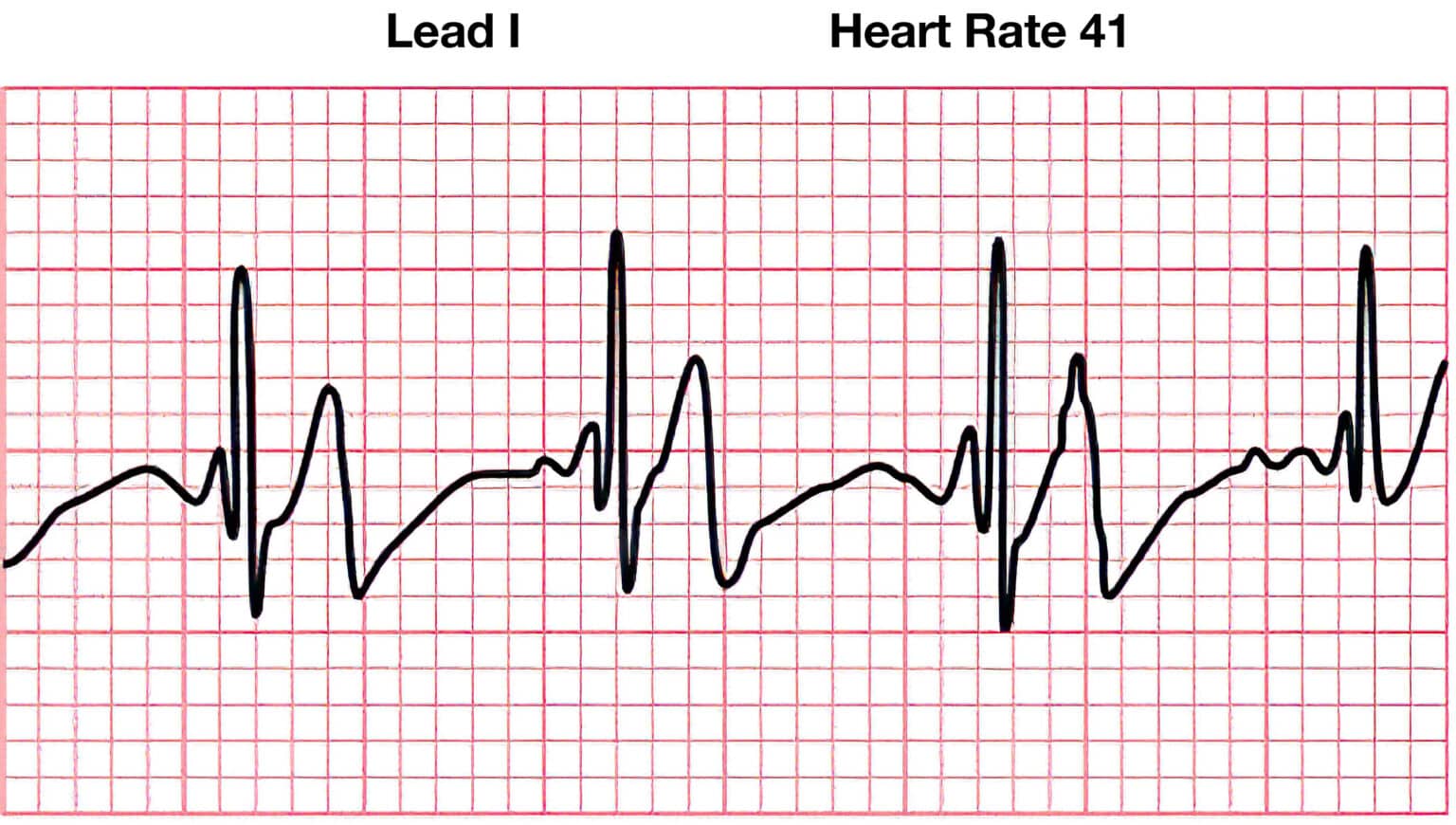 Topic - Using Pacing | ACLS EP Course | ACLS Certification Association