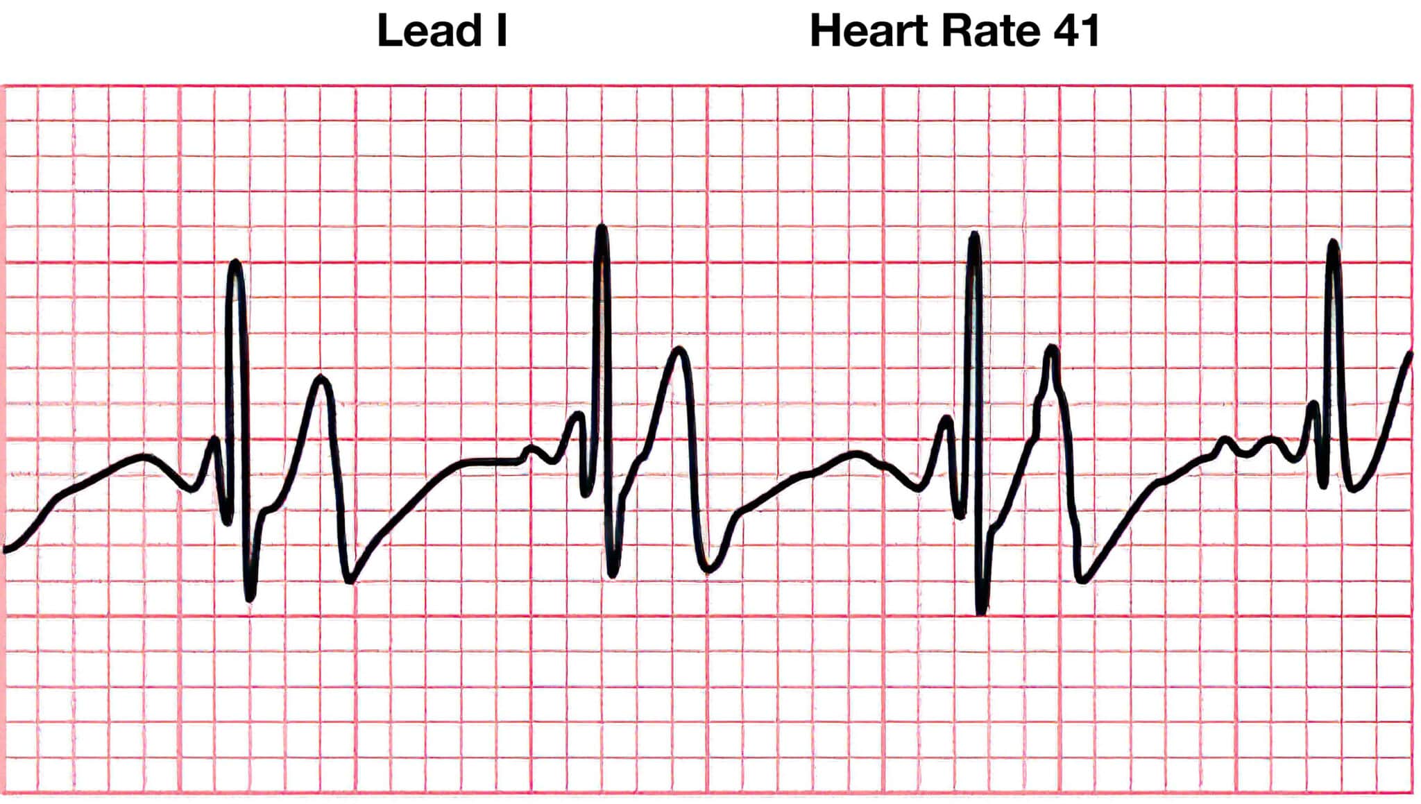 Topic - Using Pacing | ACLS EP Course | ACLS Certification Association