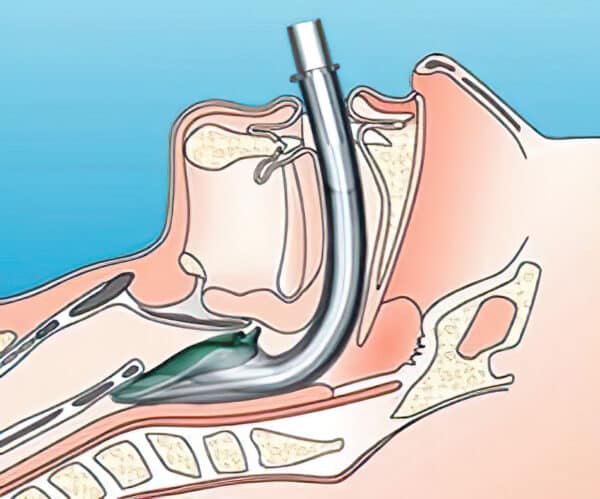 Topic - Airway Adjuncts | ACLS EP Course | ACLS Certification Association