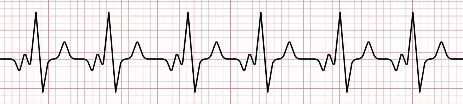 Topic - Pulseless Electrical Activity (PEA) | ACLS EP Course | ACLS ...