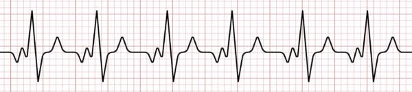 Topic - Pulseless Electrical Activity (PEA) | ACLS EP Course | ACLS ...