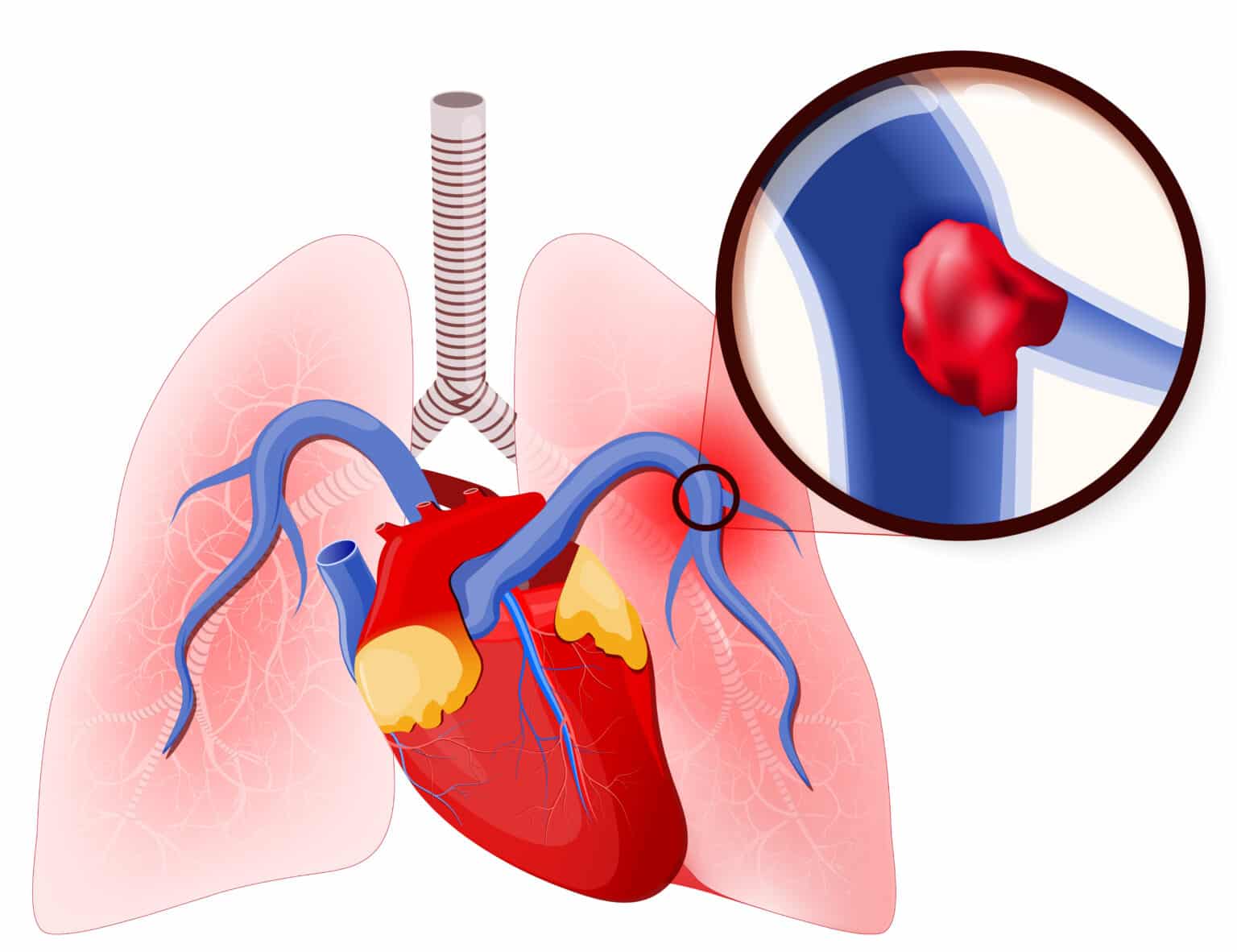Topic - Pulseless Electrical Activity (PEA) | ACLS EP Course | ACLS ...