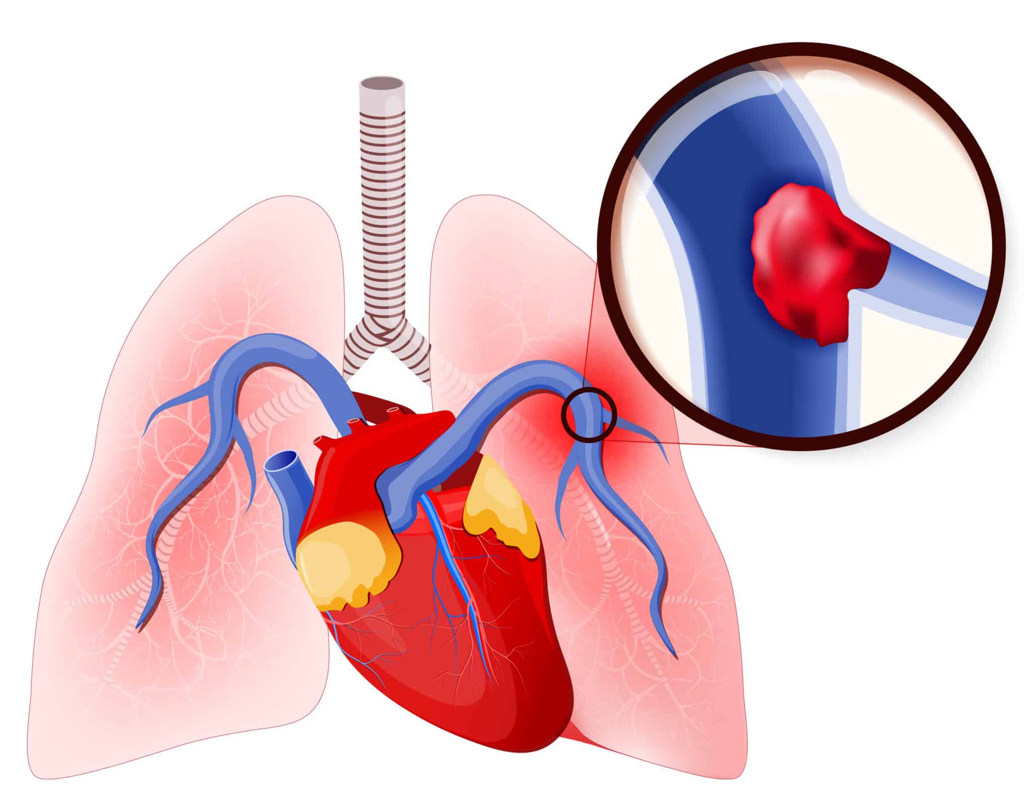Topic - Pulseless Electrical Activity (PEA) | ACLS EP Course | ACLS ...