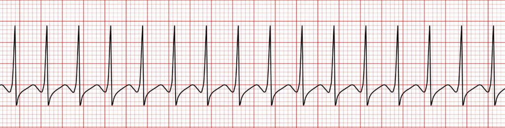 Topic - Diagnosing and Treating Tachycardias | ACLS EP Course | ACLS ...