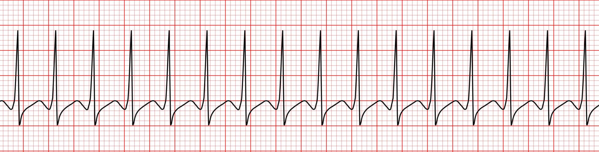 Topic - Diagnosing and Treating Tachycardias | ACLS EP Course | ACLS ...