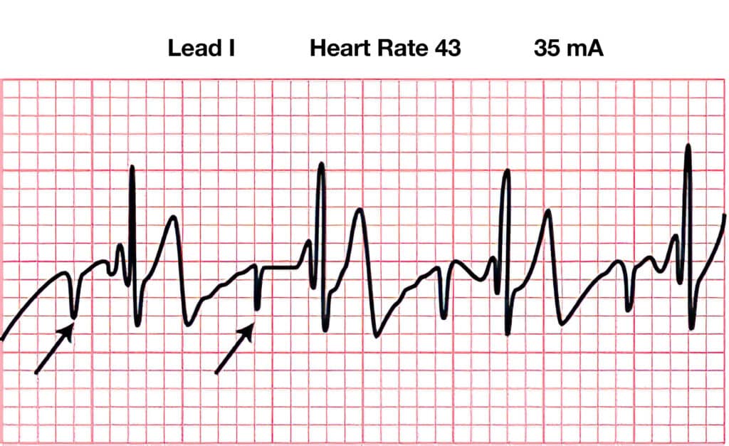 Topic - Using Pacing | ACLS EP Course | ACLS Certification Association
