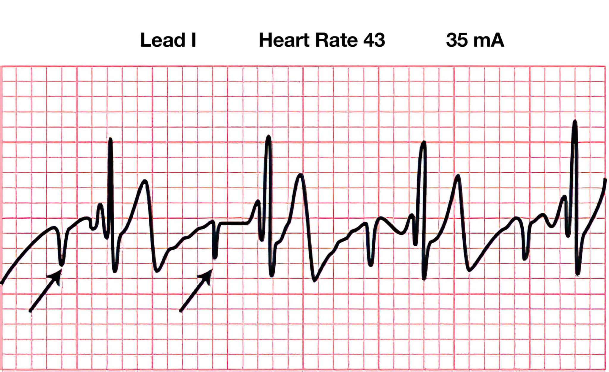 Topic - Using Pacing | ACLS EP Course | ACLS Certification Association