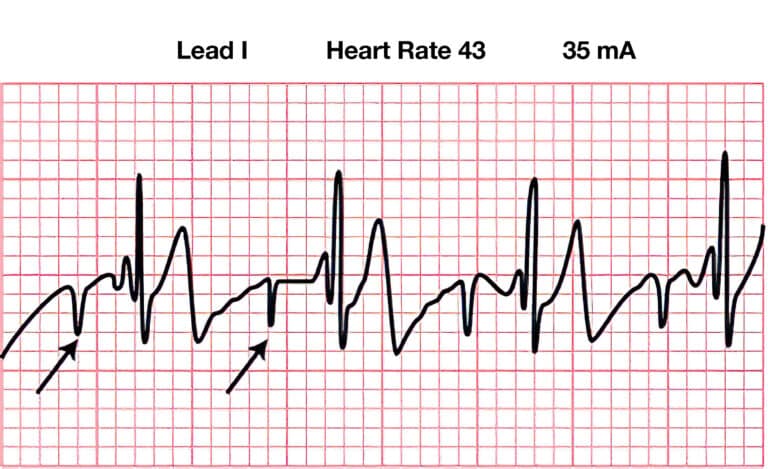 Topic - Using Pacing | ACLS EP Course | ACLS Certification Association
