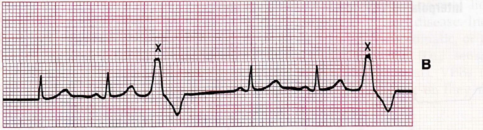 Topic - Diagnosing and Treating Tachycardias | ACLS EP Course | ACLS ...
