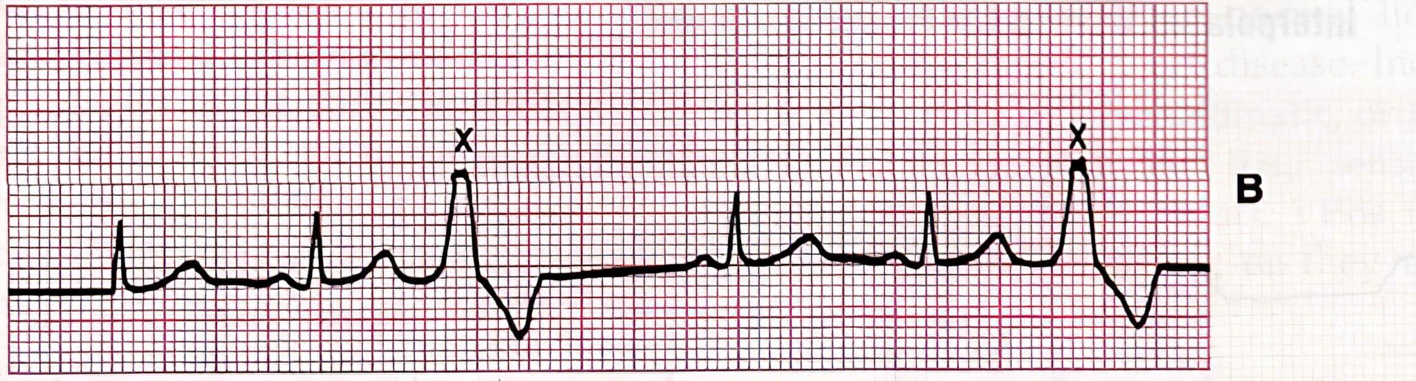 Topic - Diagnosing and Treating Tachycardias | ACLS EP Course | ACLS ...