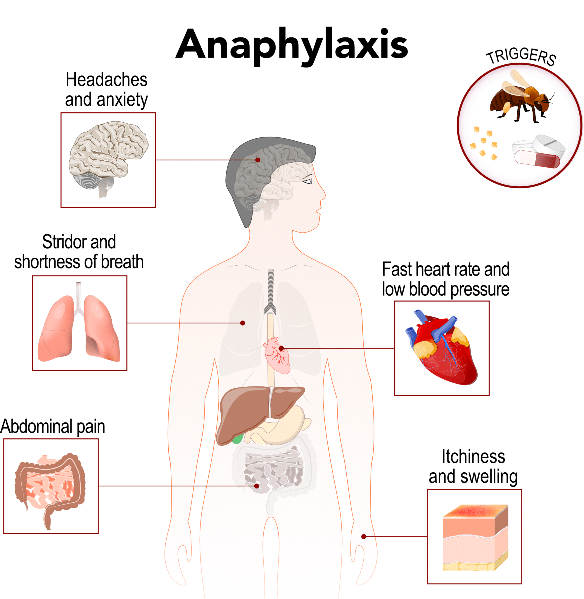 Topic - Allergic Reactions | CPR, AED & First Aid Course | ACLS ...
