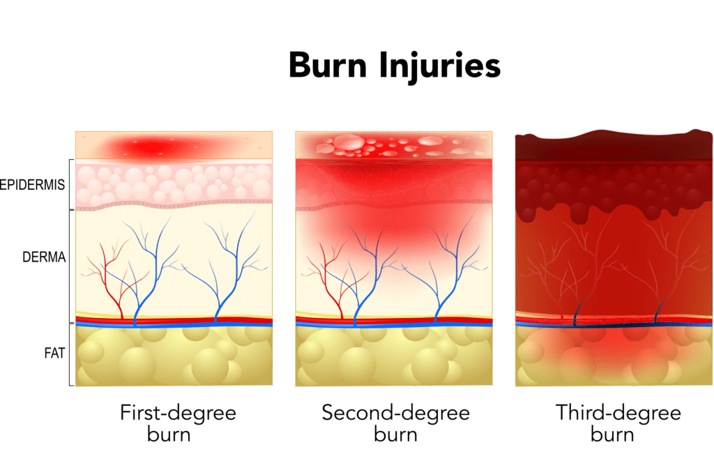 Topic - Burns | CPR, AED & First Aid Course | ACLS Certification ...