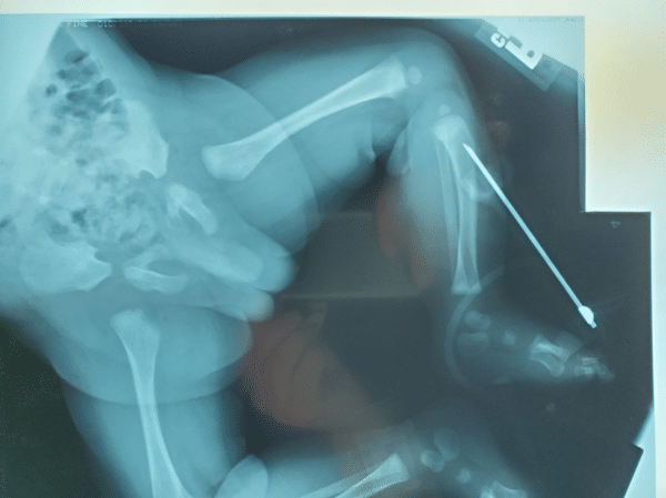 Topic - Intraosseous Needle Access | Neonatal Resuscitation Course ...