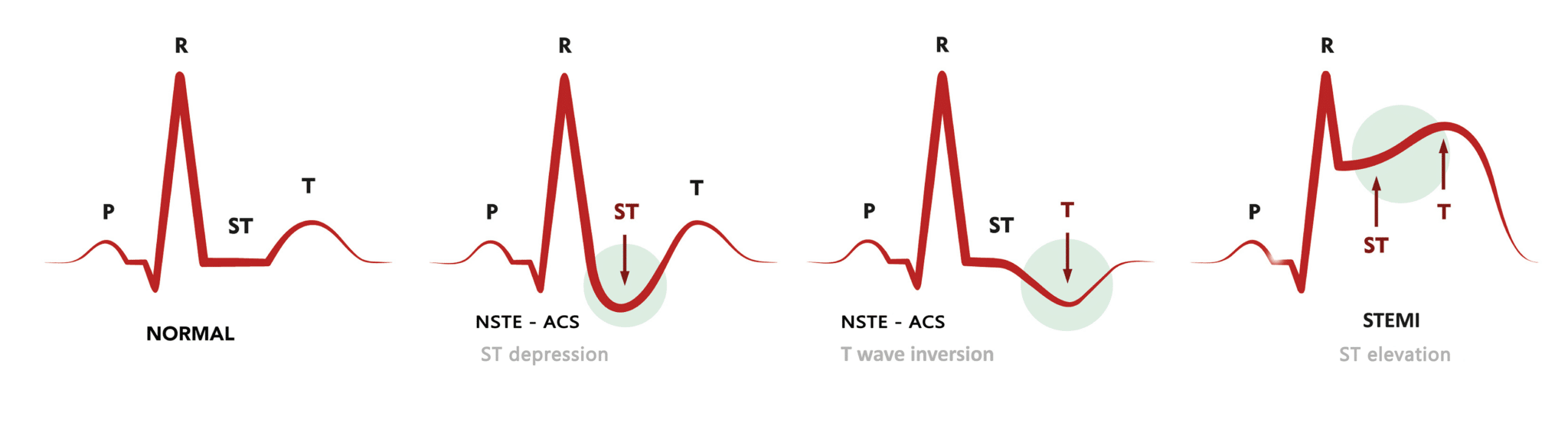 Topic - The Acute Coronary Syndrome Algorithm | ACLS EP Course | ACLS ...