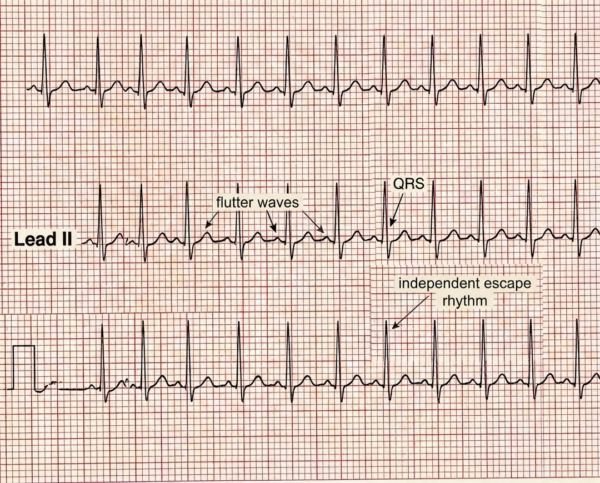 Third-Degree Complete Heart Block | ACLS Certification Association
