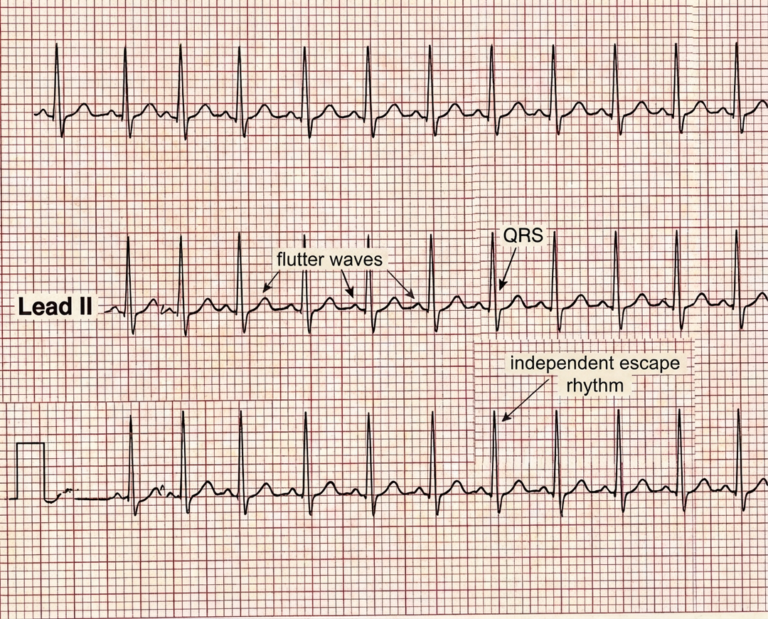 Third-Degree Complete Heart Block | ACLS Certification Association